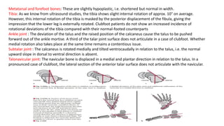 CONGENITAL TALIPES EQUINOVARUS (CLUBFOOT) Physiotherapy Dr. Apurva ...