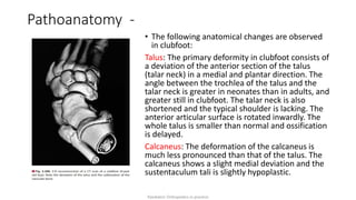 CONGENITAL TALIPES EQUINOVARUS (CLUBFOOT) Physiotherapy Dr. Apurva ...