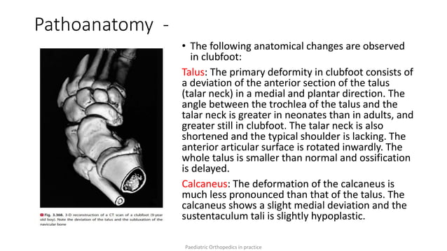 CONGENITAL TALIPES EQUINOVARUS (CLUBFOOT) Physiotherapy Dr. Apurva ...