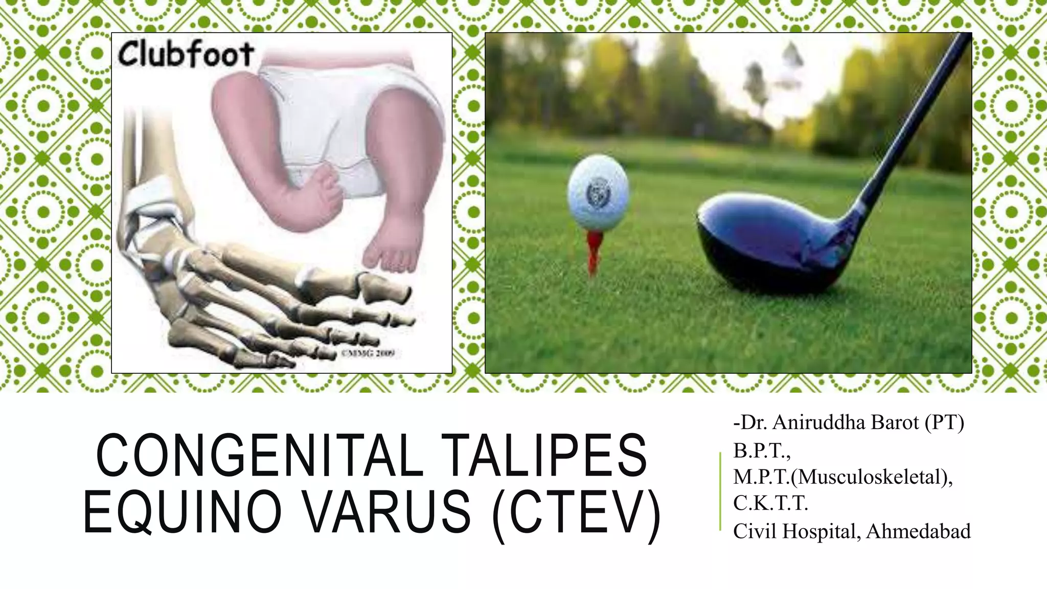 Congenital talipes equino varus (CTEV) | PPTX