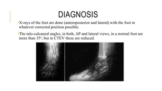 Congenital talipes equino varus (CTEV) | PPT