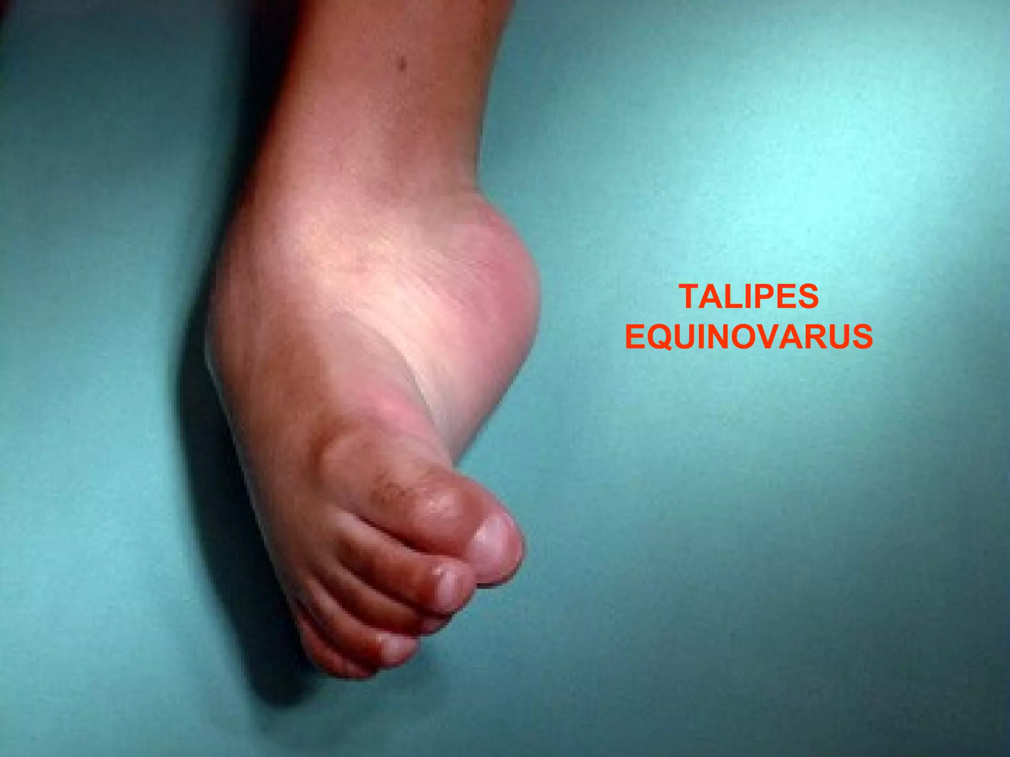 CONGENITAL TALIPES EQUINO VARUS & SPINA BIFIDA | PPT