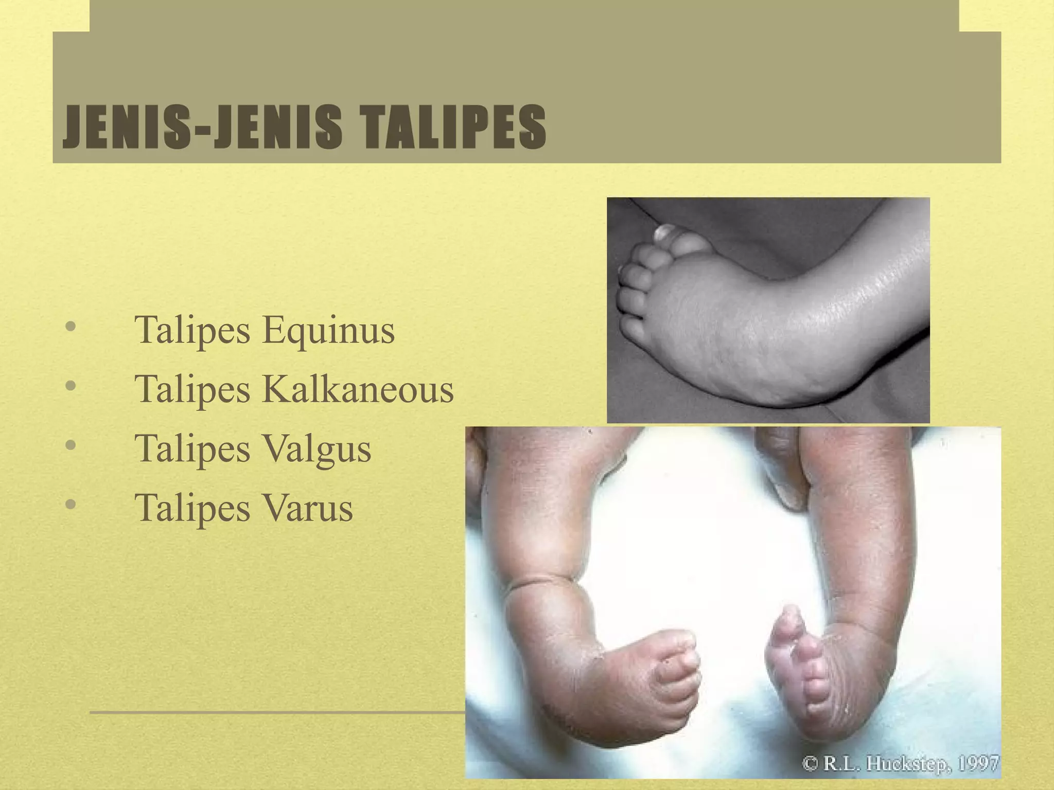 CONGENITAL TALIPES EQUINO VARUS & SPINA BIFIDA | PPT