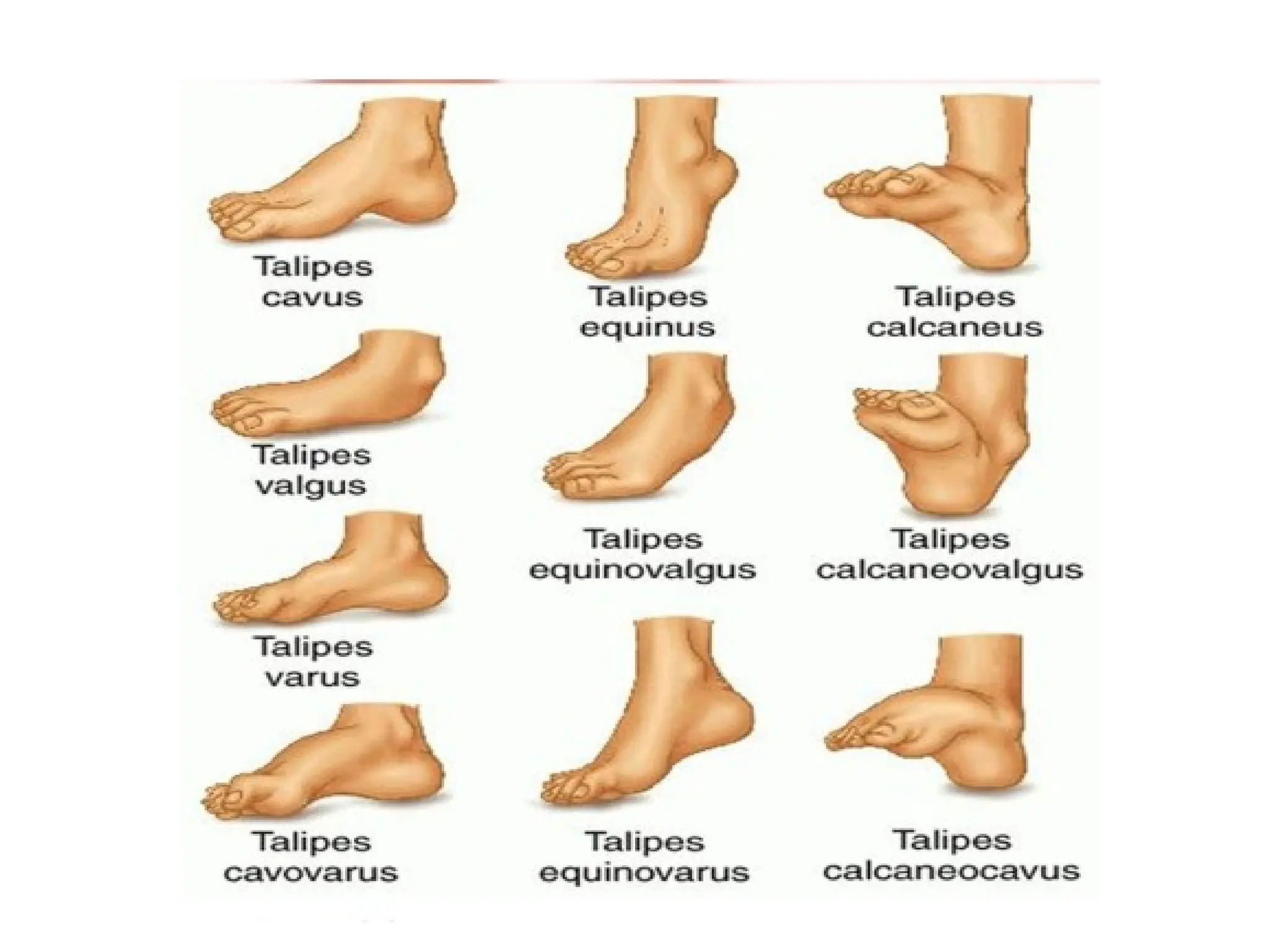 Congenital talipes equinus varus (CTEV).pptx