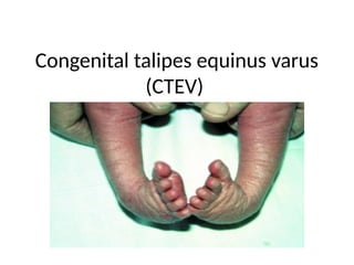 Congenital talipes equinus varus (CTEV).pptx