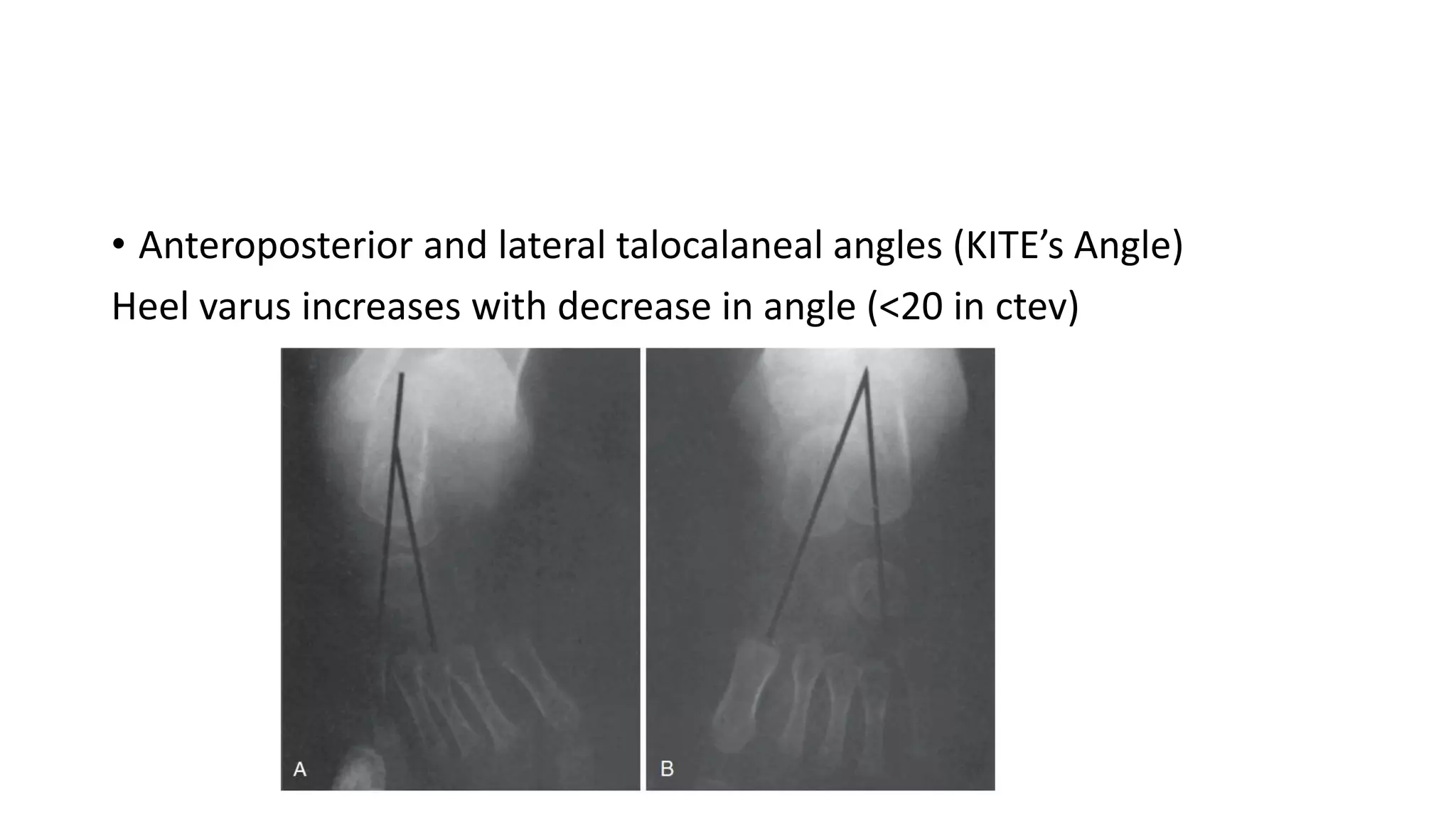 Congenital tallipes equinovarus | PPTX