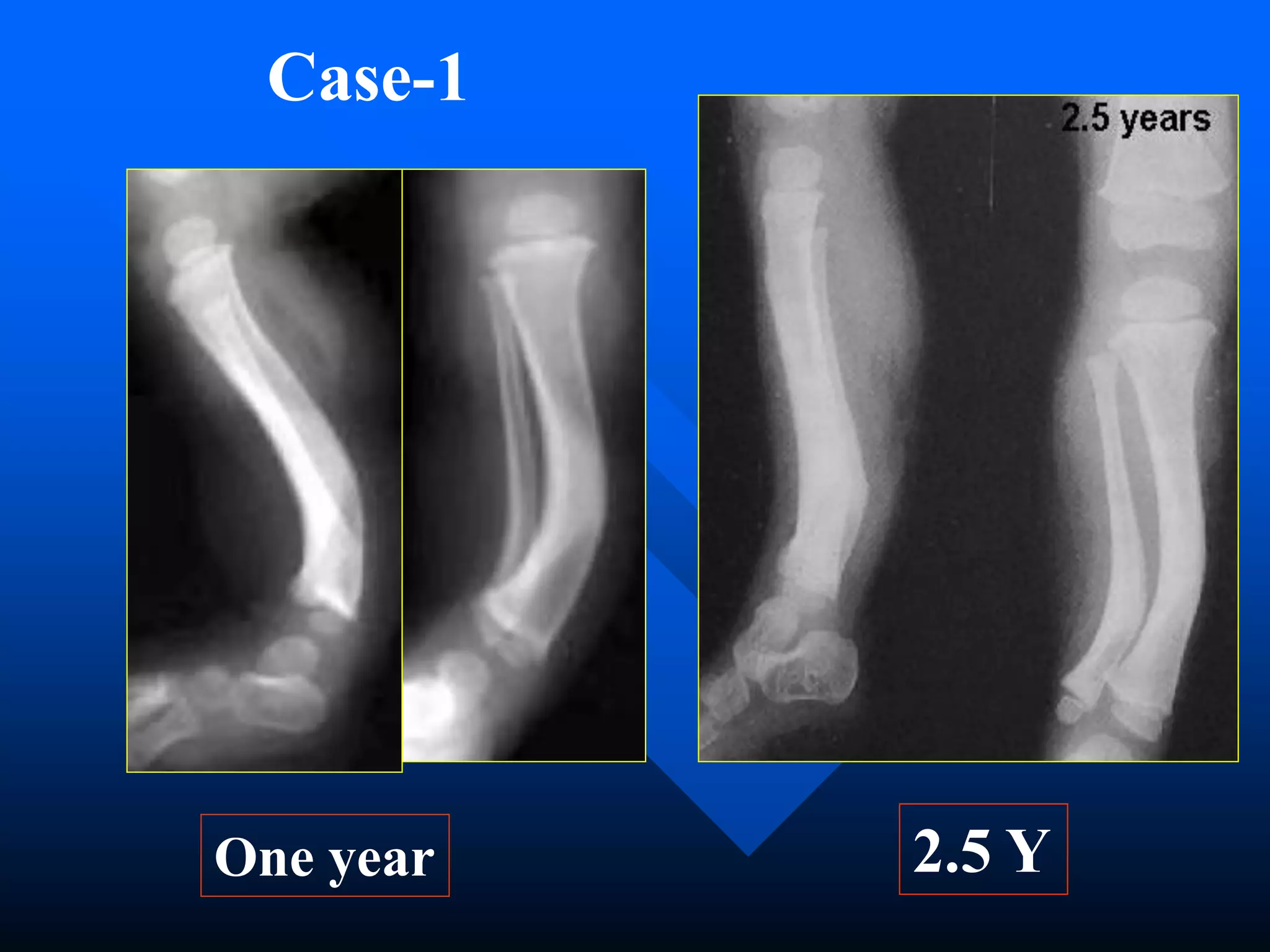 تقوس الساق الخلقي - Congenital tibial angulation البروفيسور فريح ...