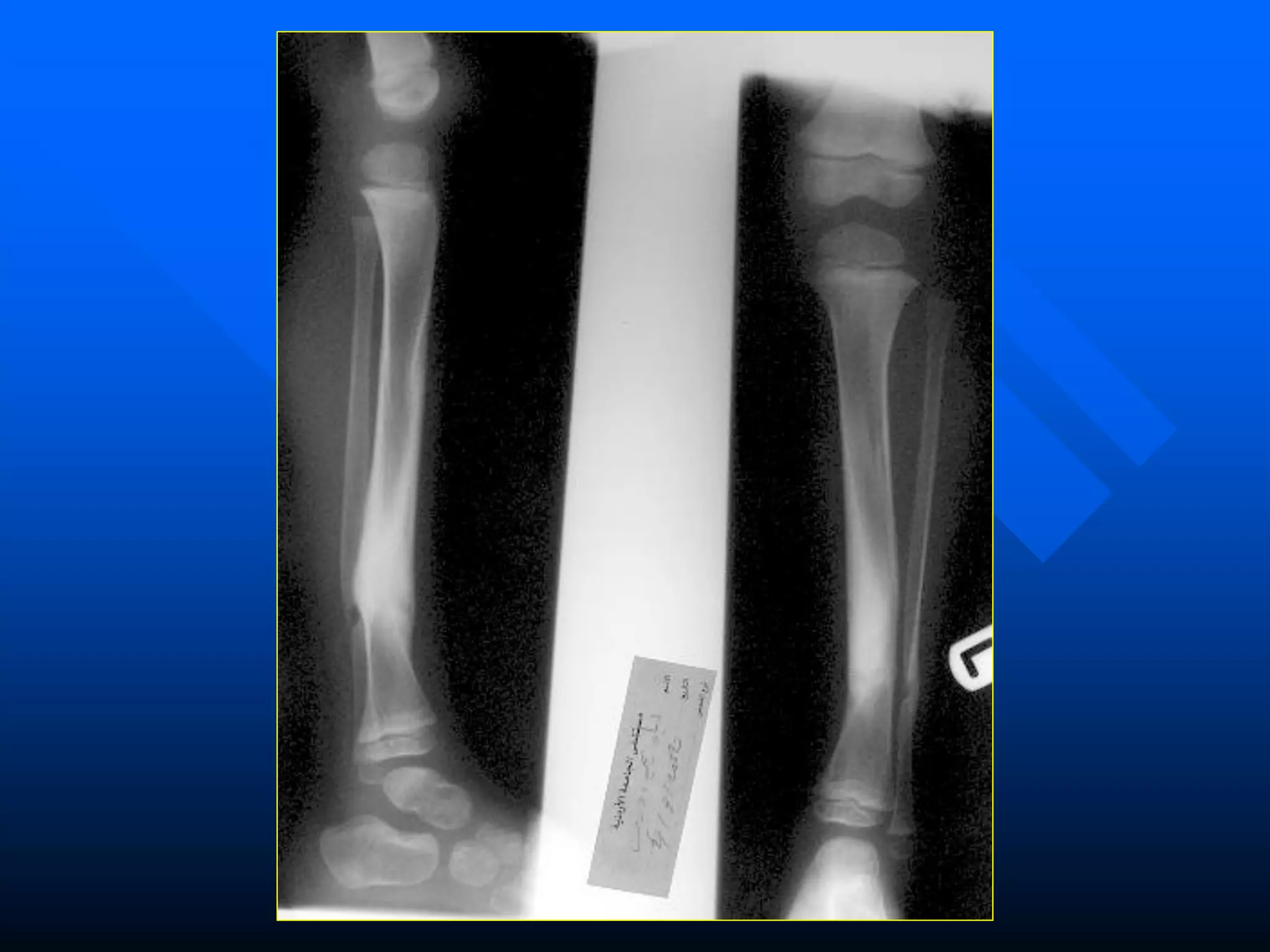 تقوس الساق الخلقي - Congenital tibial angulation البروفيسور فريح ...