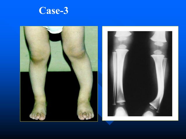 تقوس الساق الخلقي - Congenital tibial angulation البروفيسور فريح ...