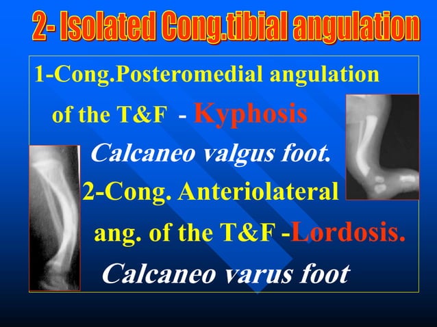 تقوس الساق الخلقي - Congenital tibial angulation البروفيسور فريح ...