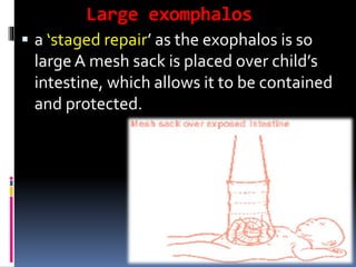 Congenital umblical hernia | PPTX