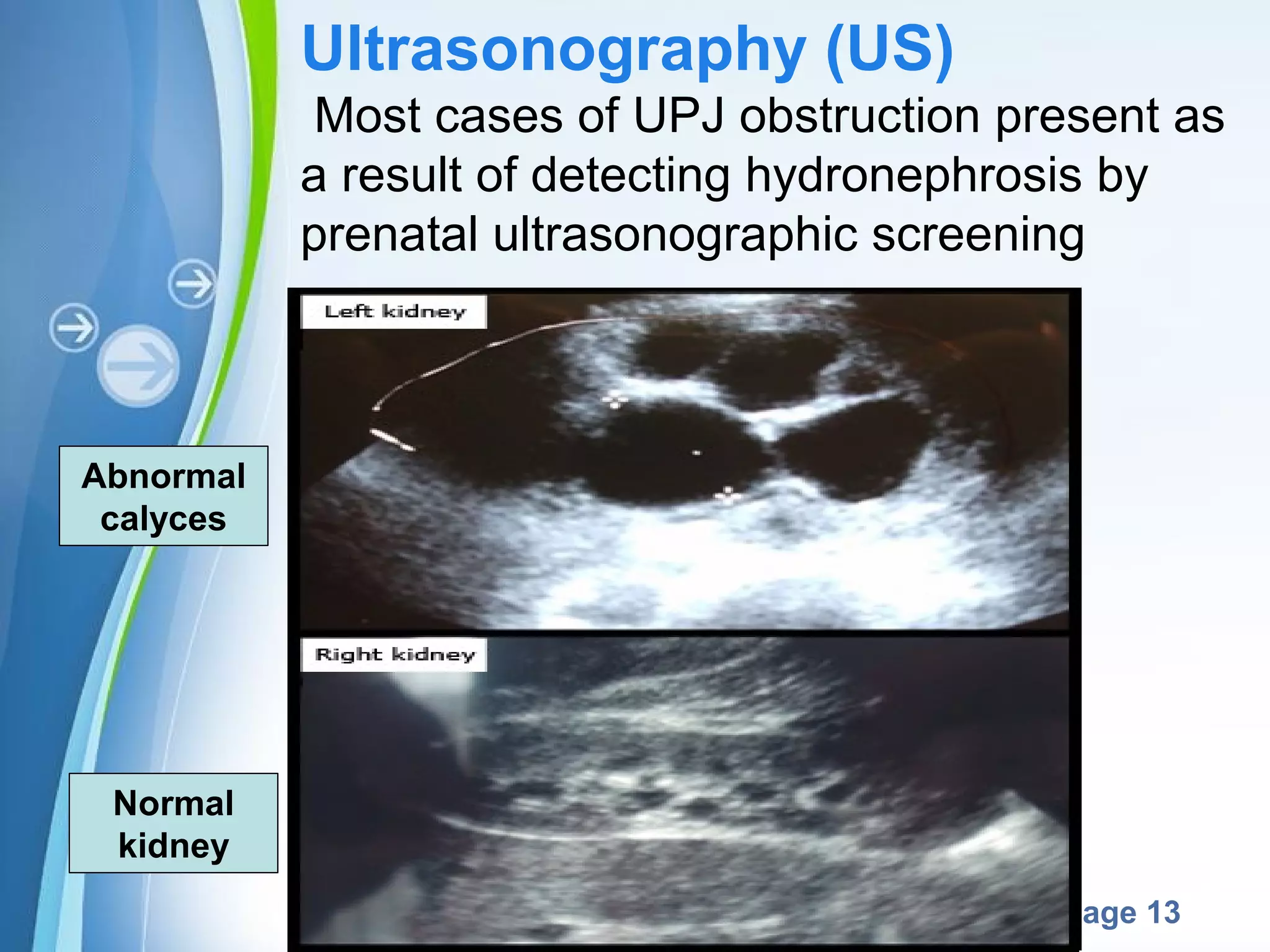 Congenital ureteropelvic (upj) obstruction | PPT | Digestive Disorders ...