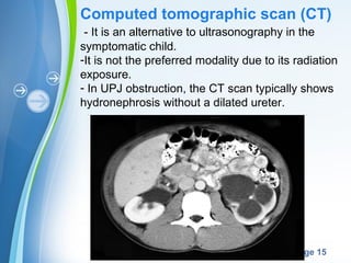 Congenital ureteropelvic (upj) obstruction | PPT