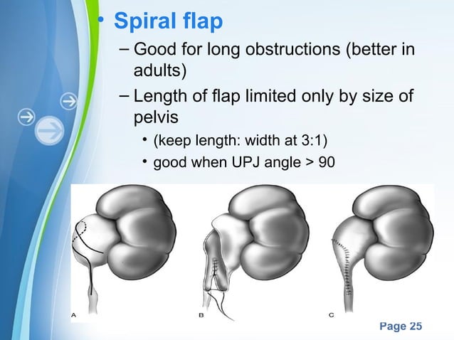 Congenital ureteropelvic (upj) obstruction | PPT | Digestive Disorders ...