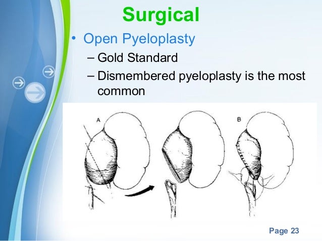 Congenital ureteropelvic (upj) obstruction