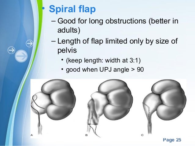 Congenital ureteropelvic (upj) obstruction