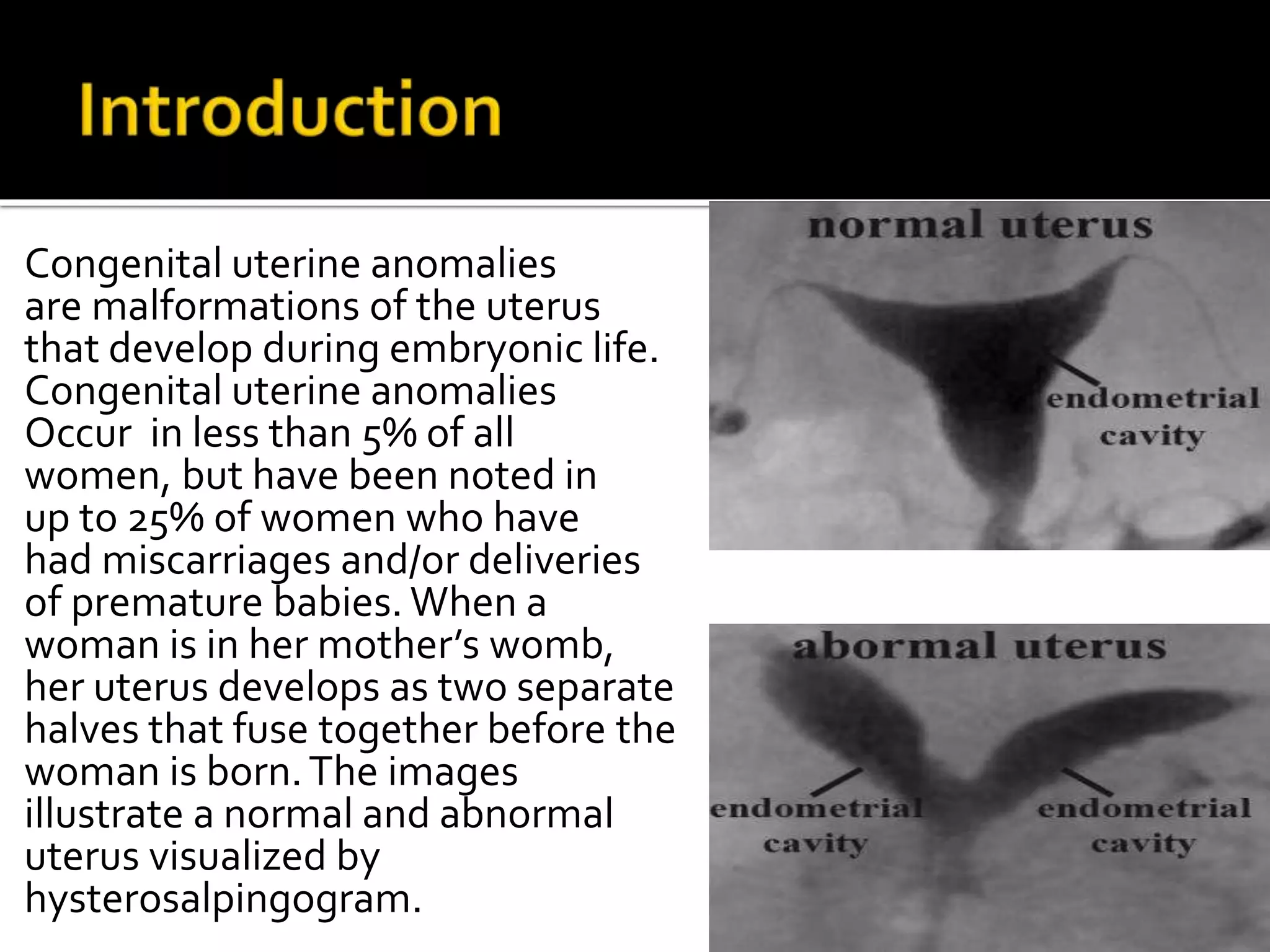 Congenital uterine anomaly | PPTX
