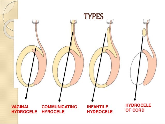 Congenital Vaginal Hydrocele Dr Anthony