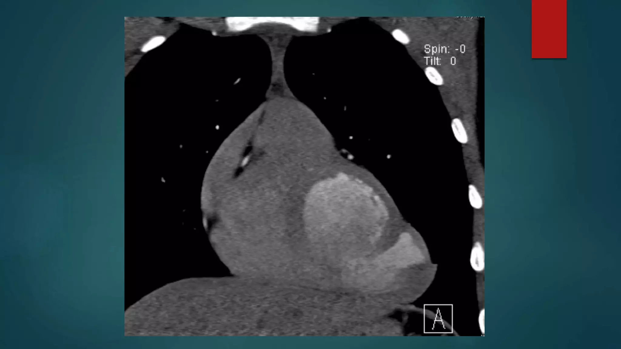 Congenital ventricular outpouchings (CVOs) | PPTX