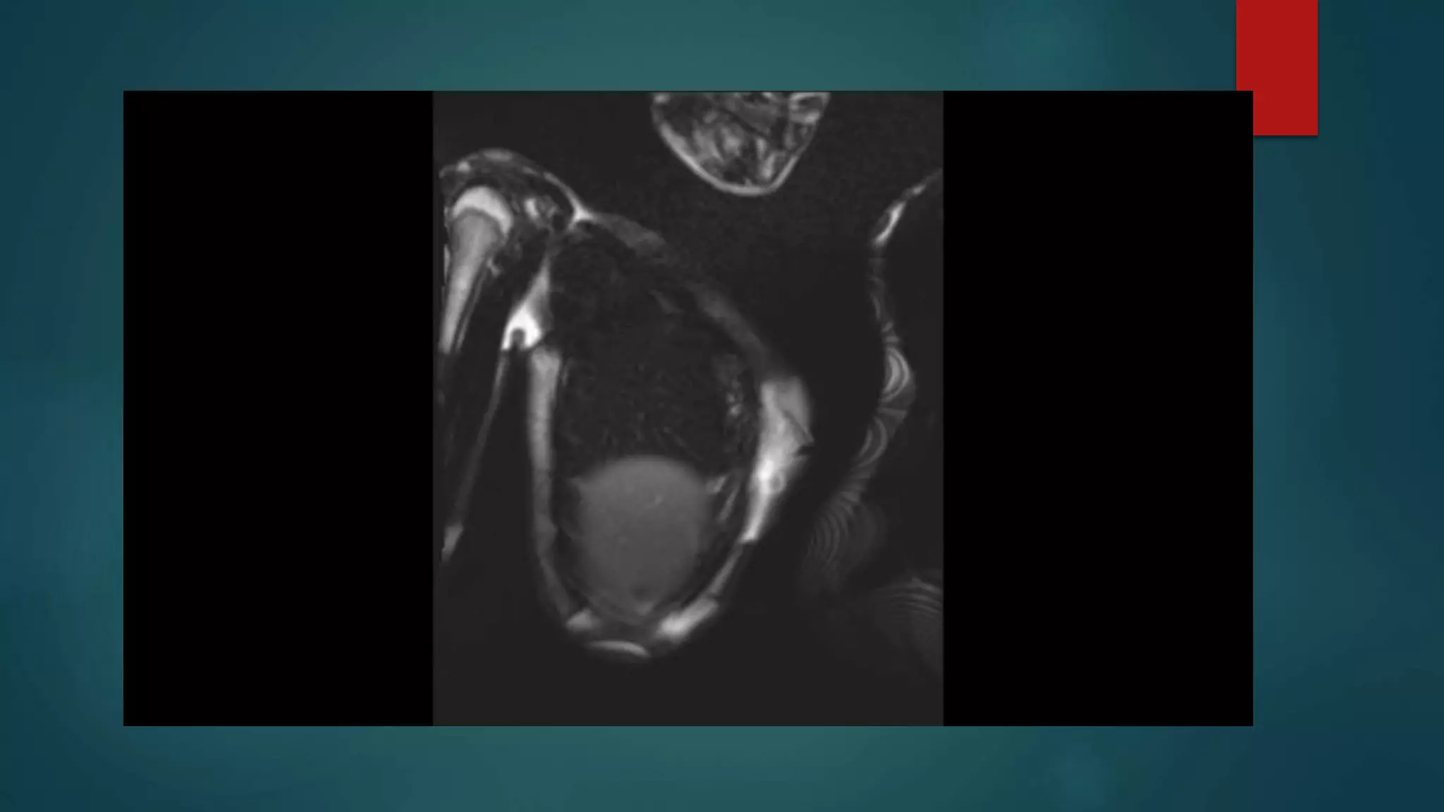 Congenital ventricular outpouchings (CVOs) | PPTX