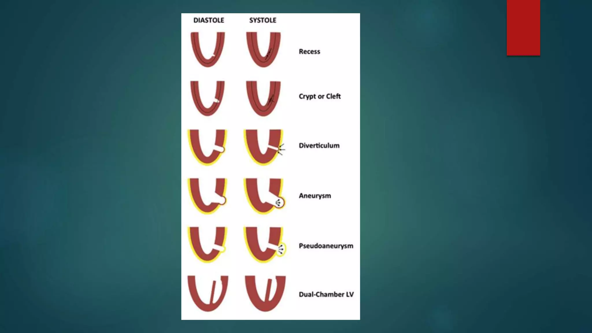 Congenital ventricular outpouchings (CVOs) | PPTX