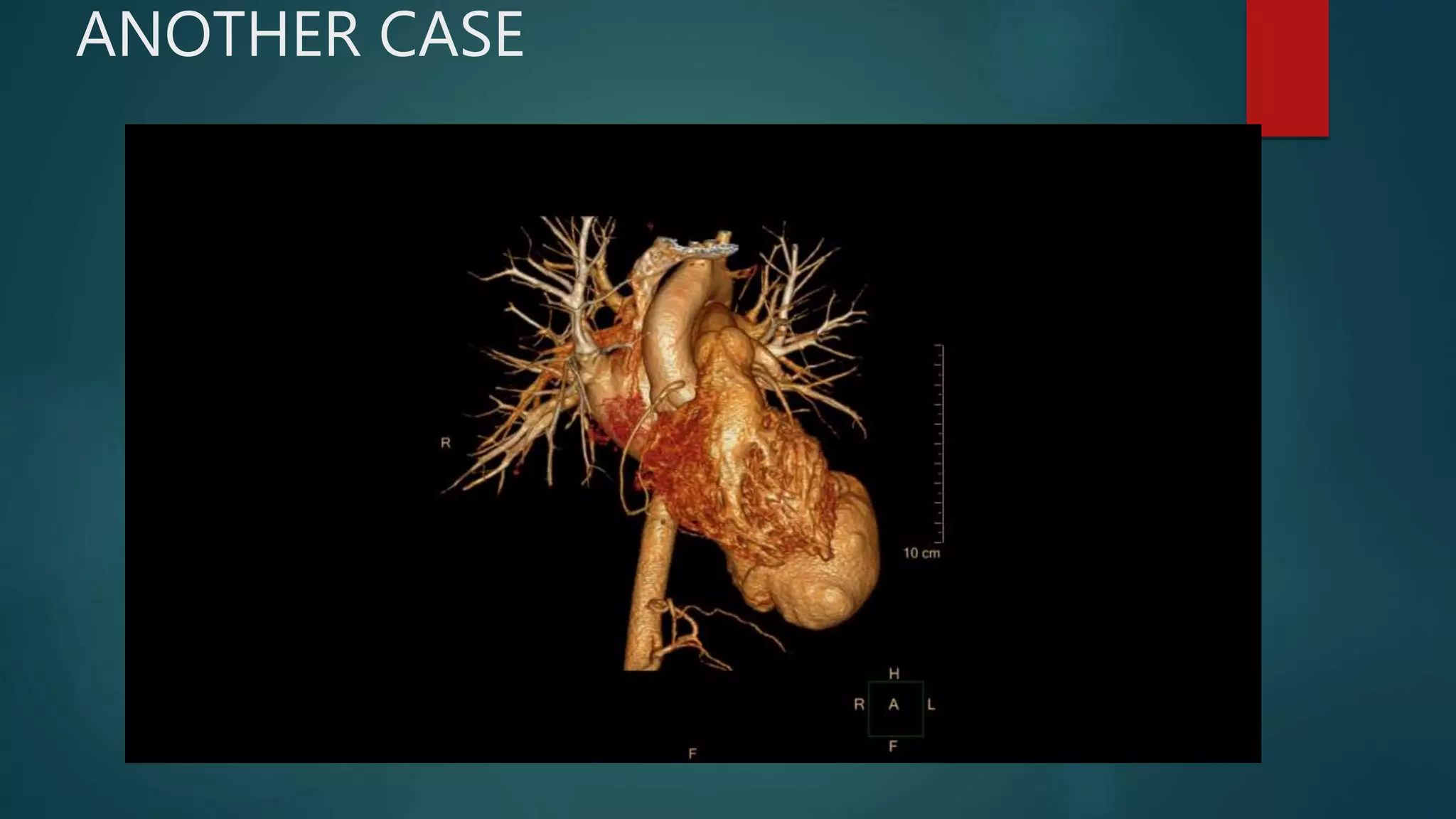 Congenital ventricular outpouchings (CVOs) | PPTX