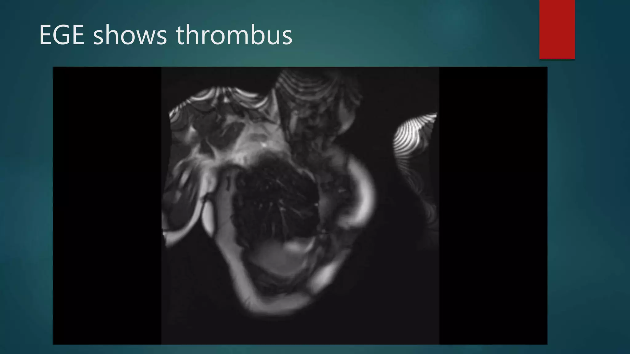Congenital ventricular outpouchings (CVOs) | PPTX