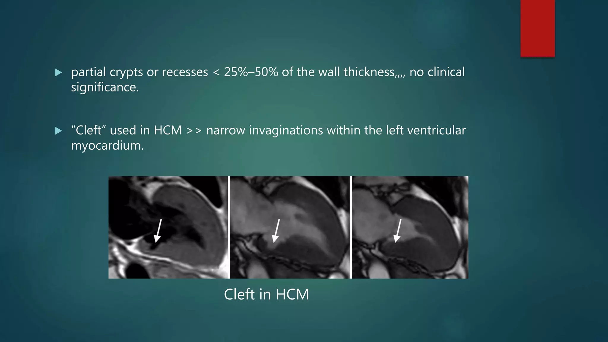 Congenital ventricular outpouchings (CVOs) | PPTX