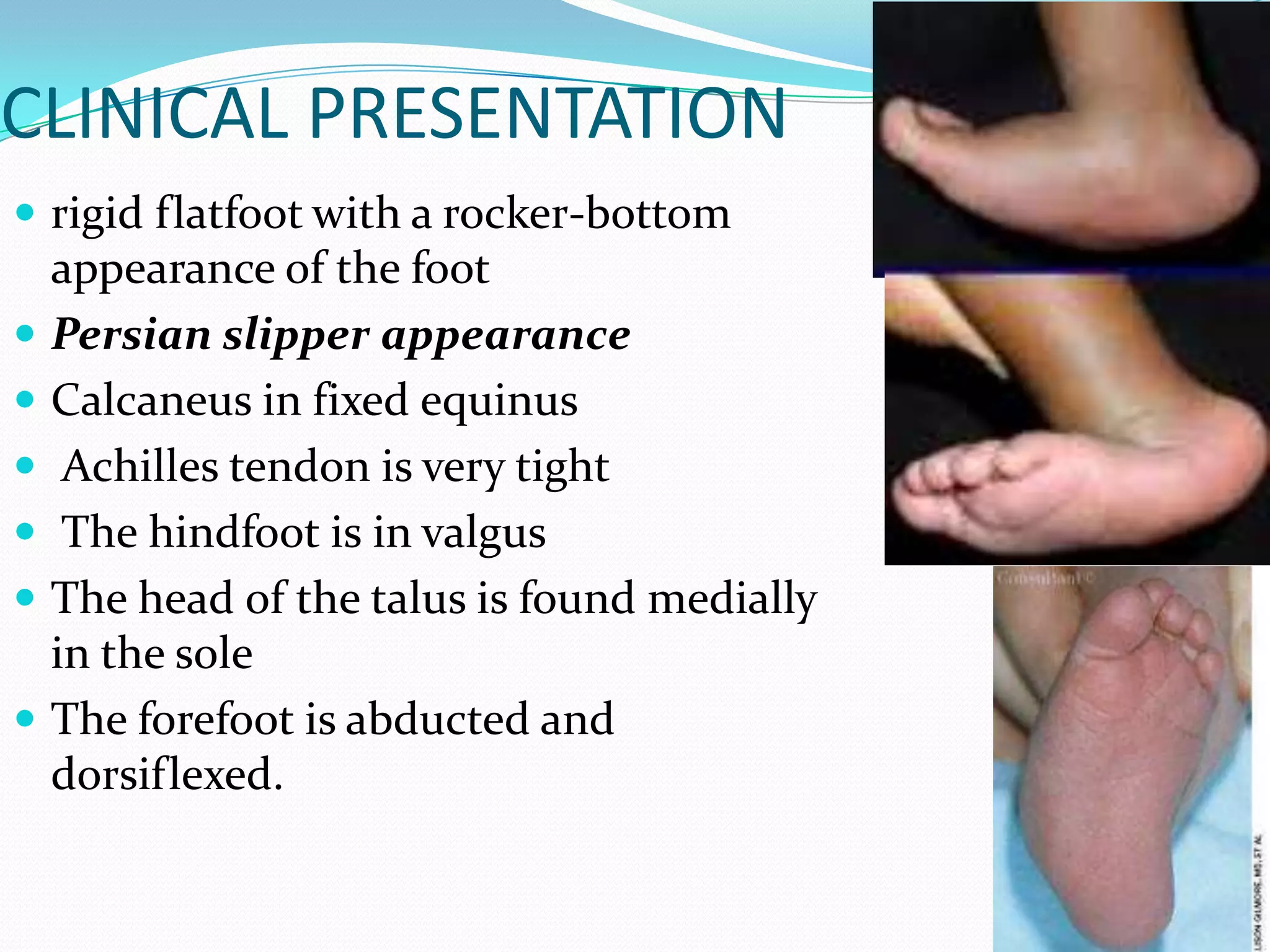 Congenital vertical talus UG lecture | PPTX
