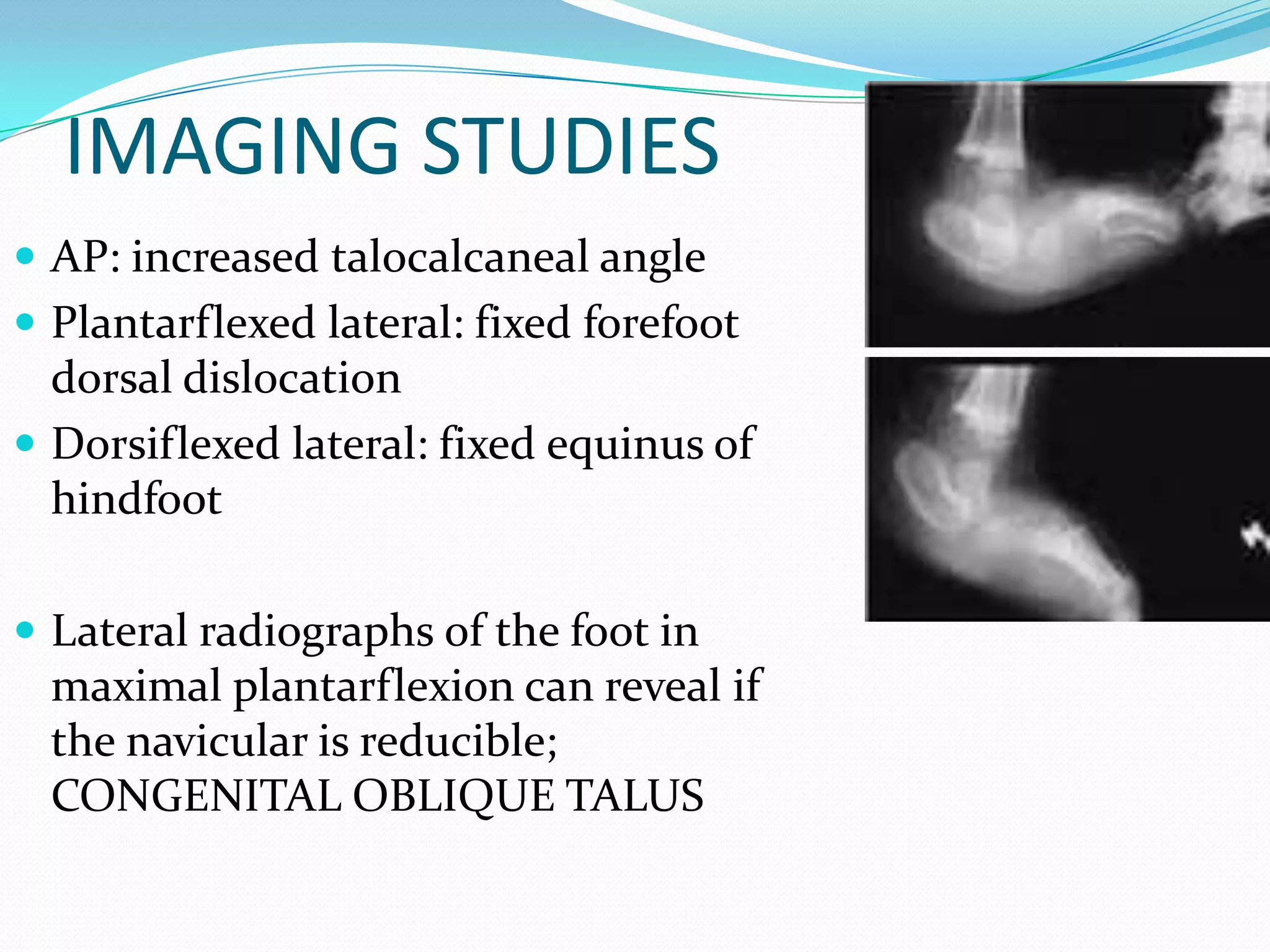 Congenital vertical talus UG lecture | PPTX