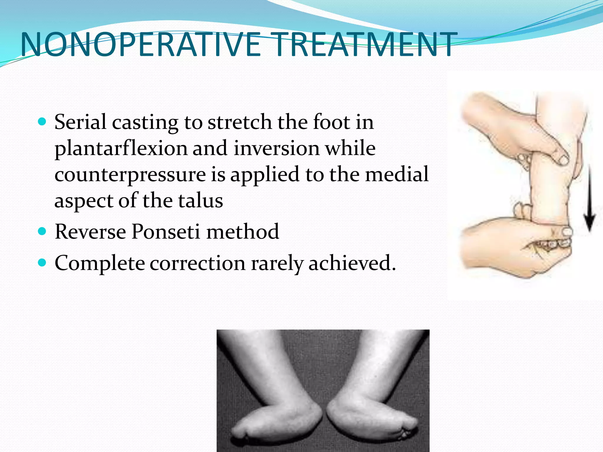 Congenital vertical talus UG lecture | PPTX