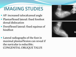 Congenital vertical talus UG lecture | PPTX
