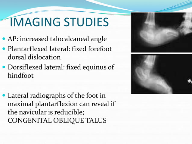 Congenital vertical talus UG lecture | PPTX | Death, Injury, or ...
