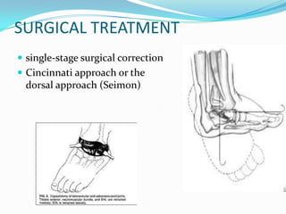 Congenital vertical talus UG lecture | PPTX