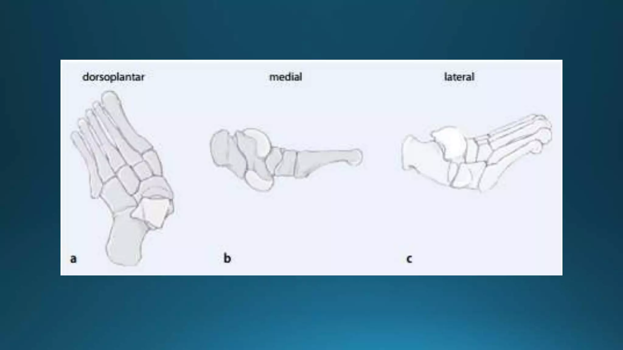 Congenital vertical talus | PPTX