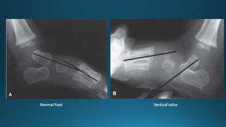 Congenital vertical talus | PPTX