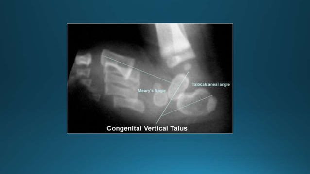 Congenital vertical talus | PPTX