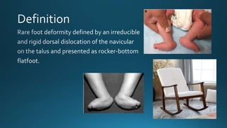 Congenital vertical talus | PPTX