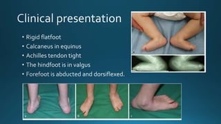 Congenital vertical talus | PPTX