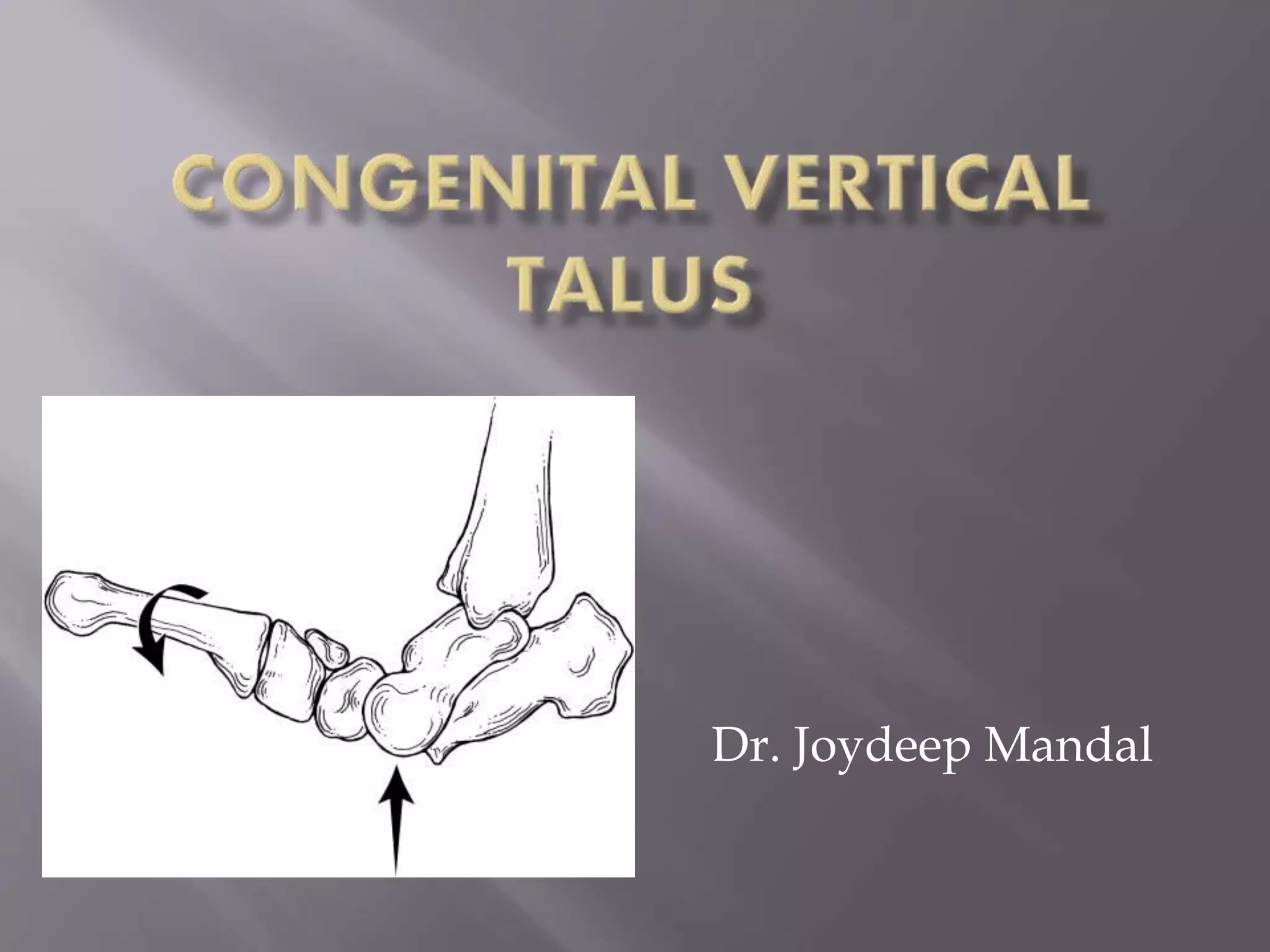 Congenital vertical talus | PPTX