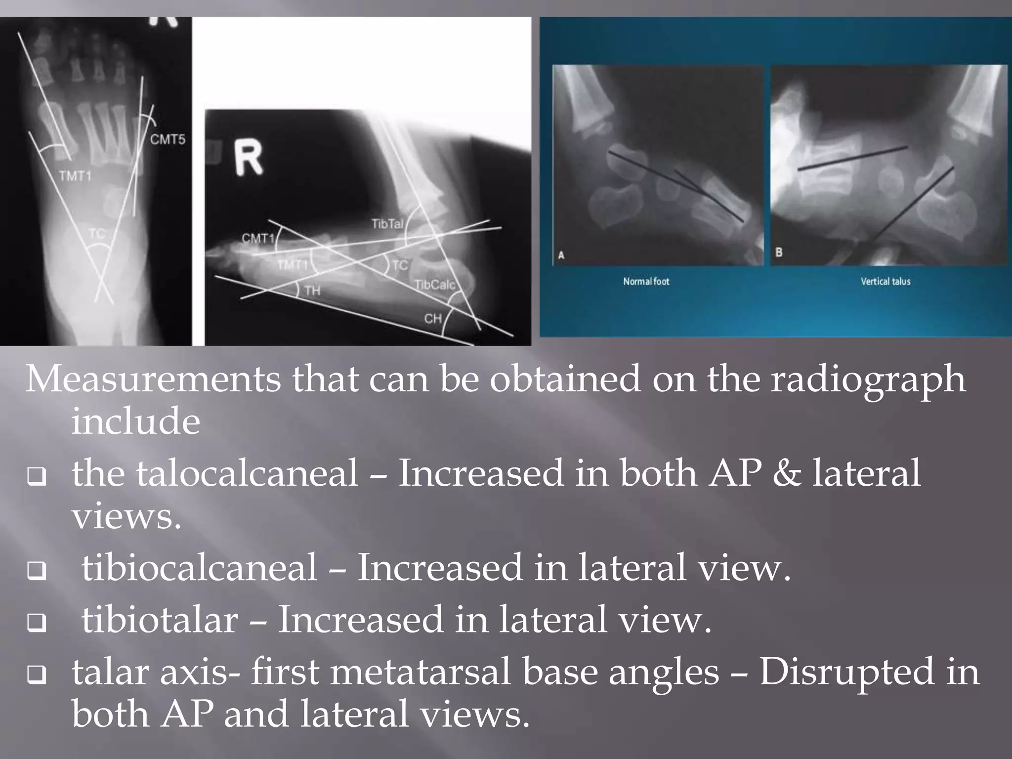 Congenital vertical talus | PPT | Free Download
