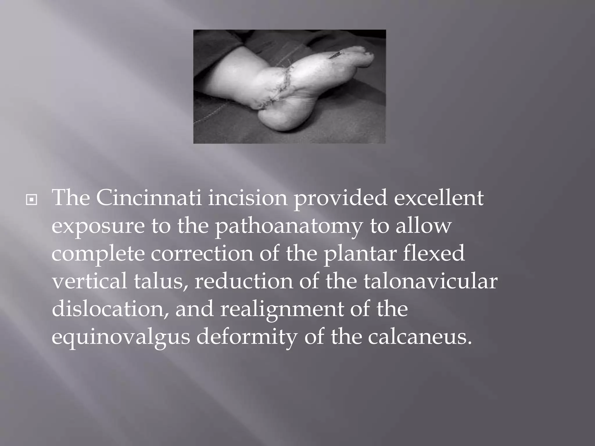 Congenital vertical talus | PPTX