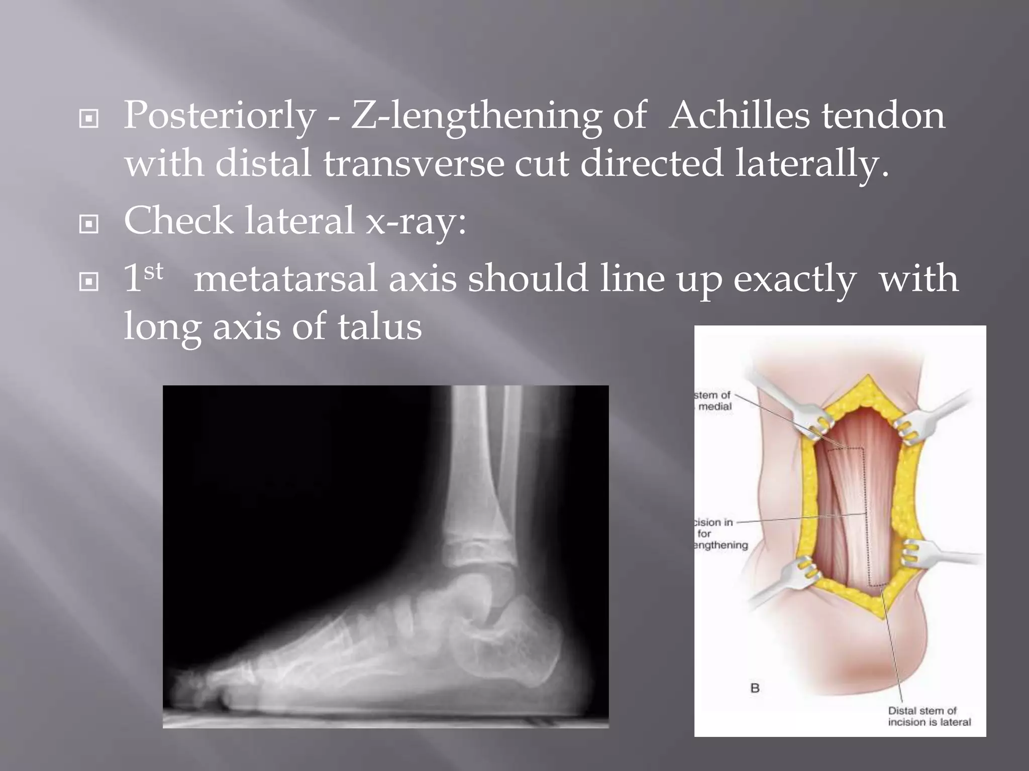Congenital vertical talus | PPTX