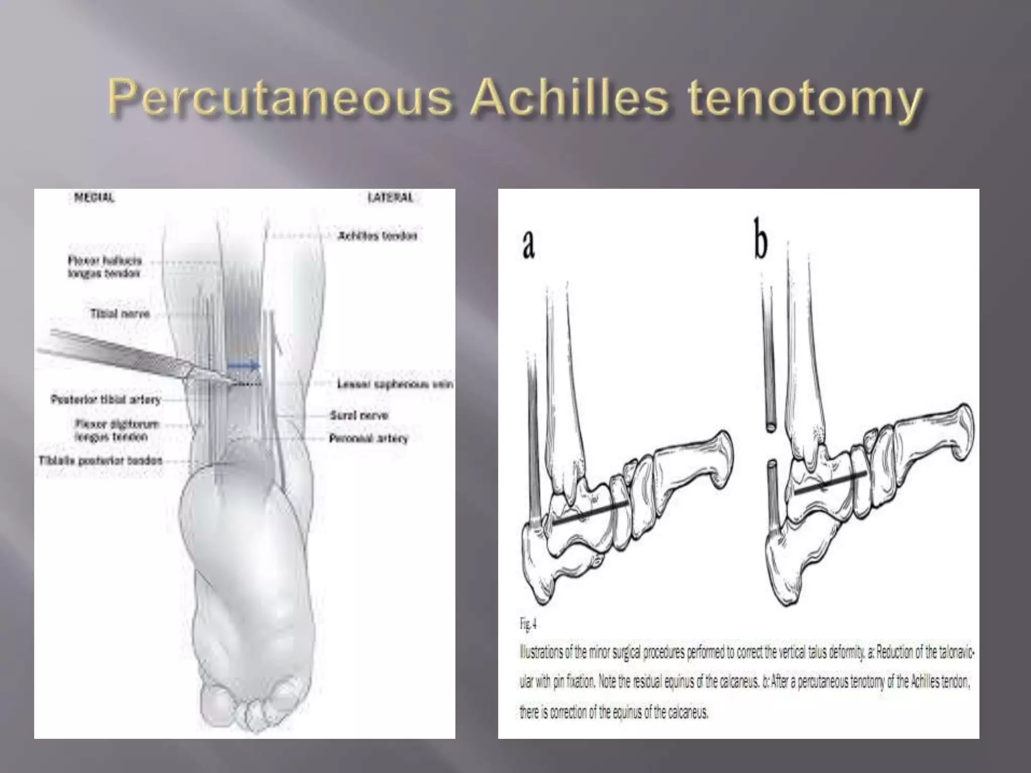 Congenital vertical talus | PPTX