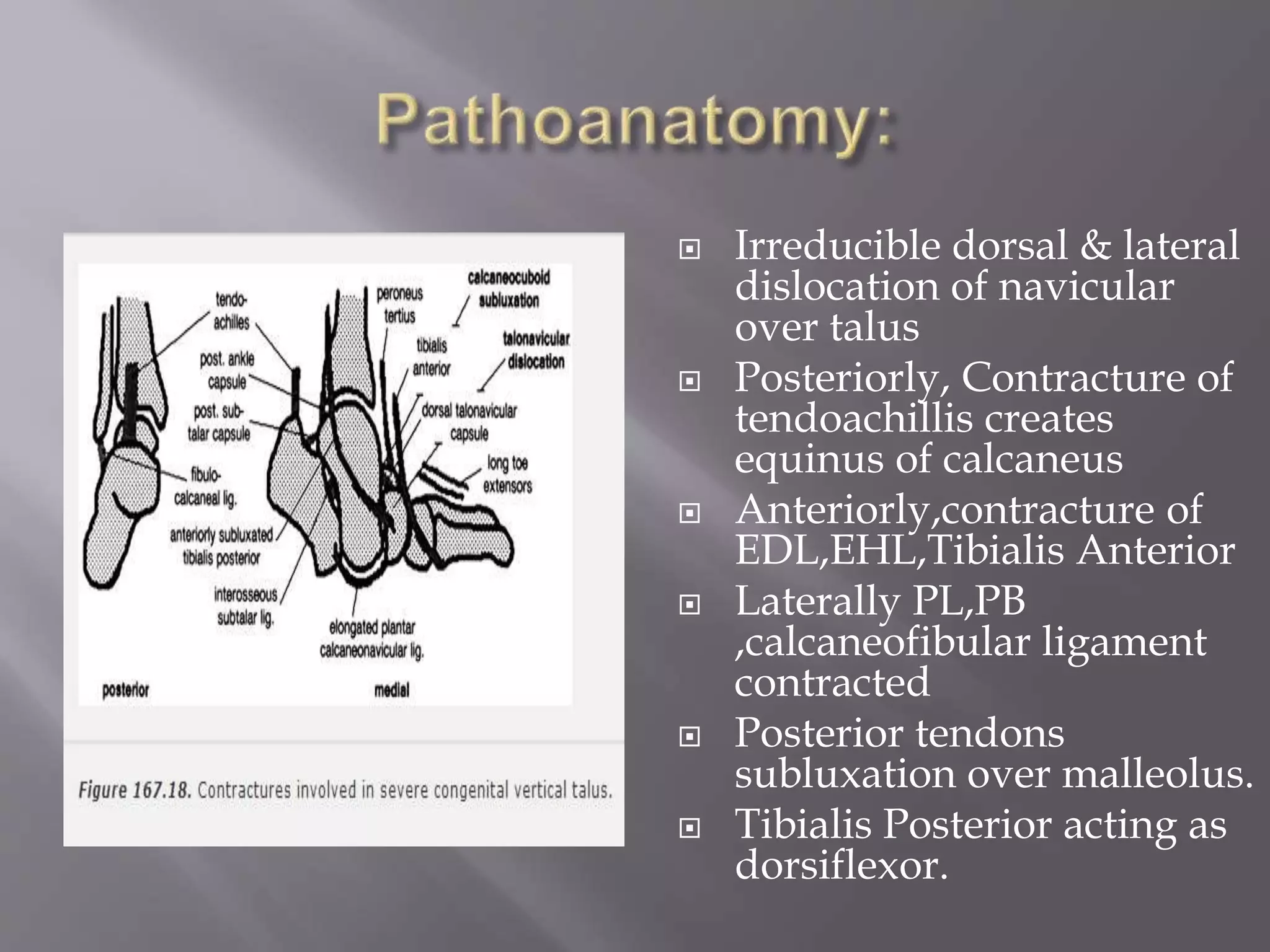 Congenital vertical talus | PPTX