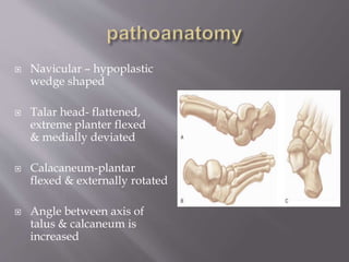 Congenital vertical talus | PPTX