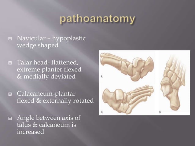 Congenital vertical talus | PPT | Free Download