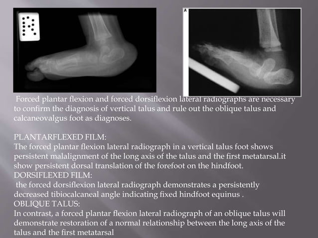 Congenital vertical talus | PPTX