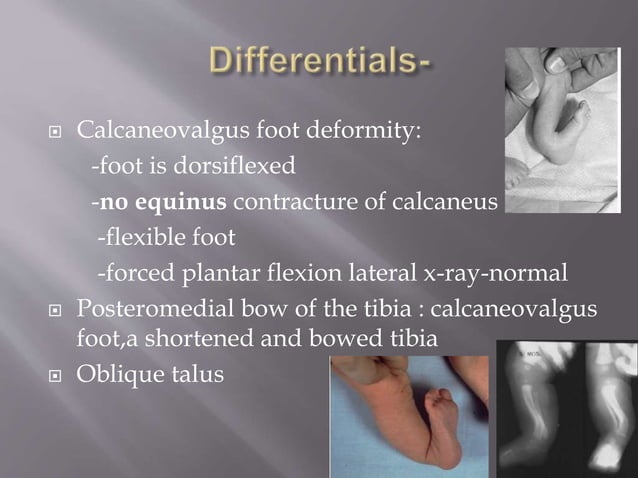 Congenital vertical talus | PPTX