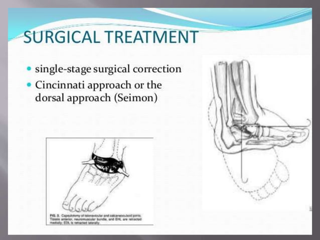 Congenital vertical talus | PPTX